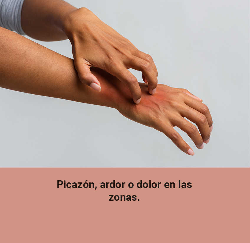 Psoriasis - Síntomas | Mas Alla De La Piel